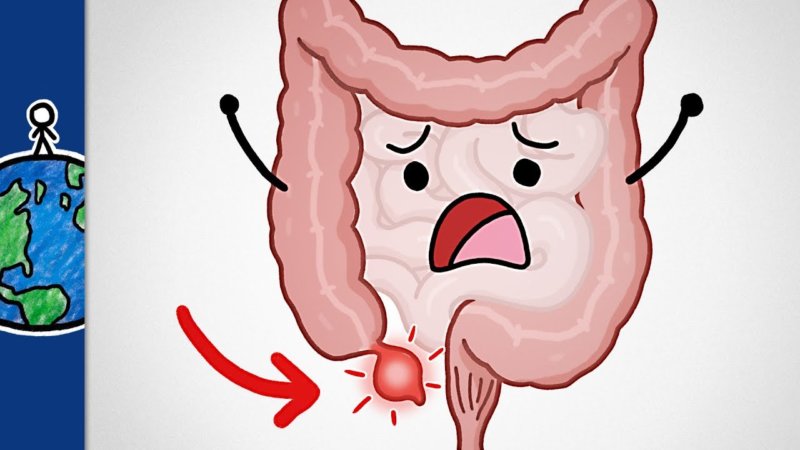 The Mystery of The Exploding Appendix – INTHEFAME